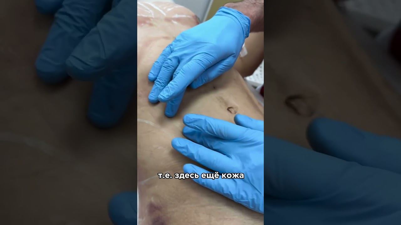 Результат мужской липоскульптуры