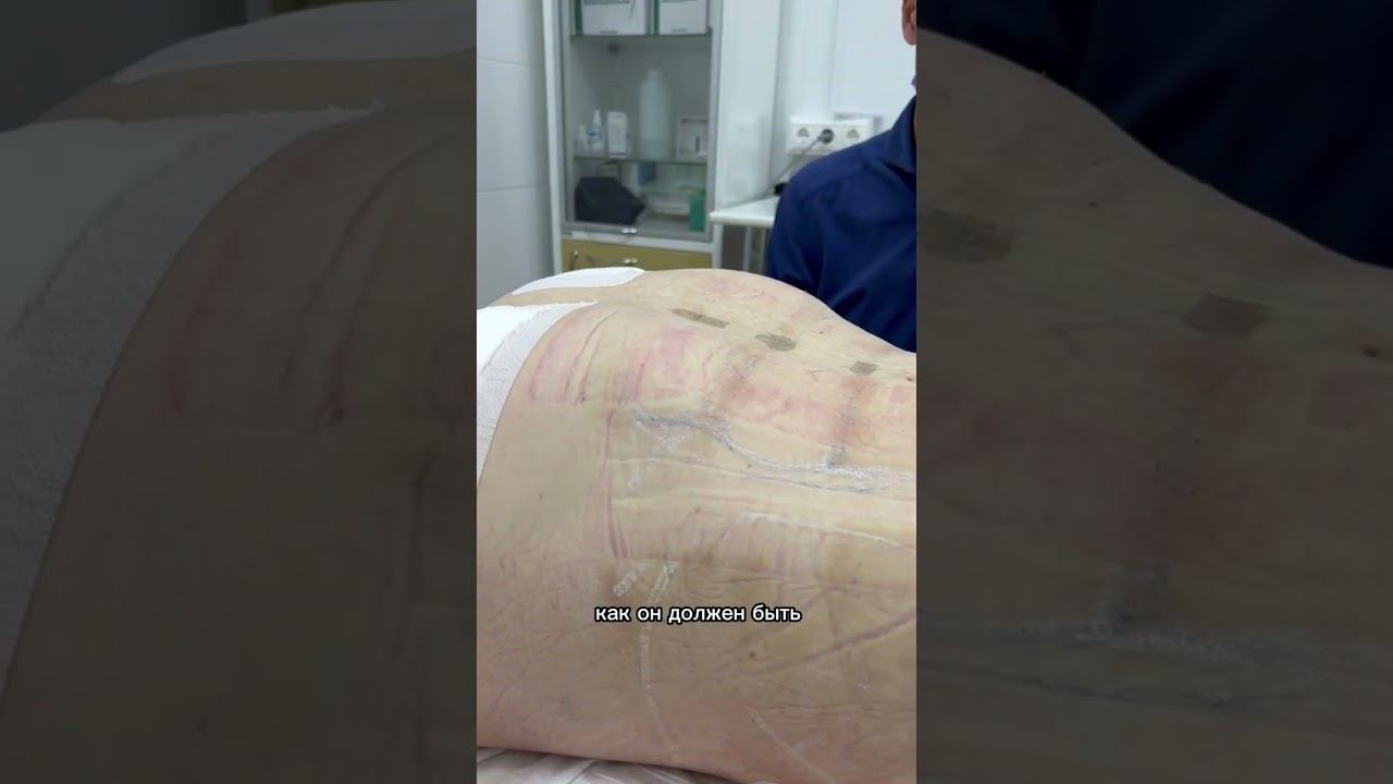 Липоскульптура: 1 день после операции