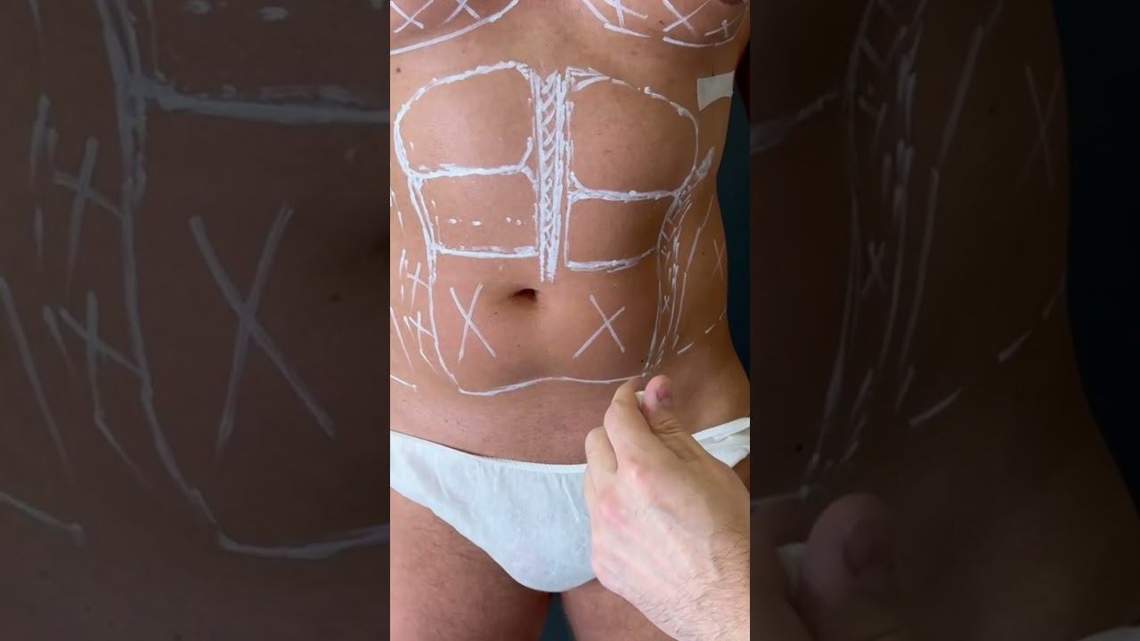 Мужская липоскульптура #липоскульптурирование #кубикипресса