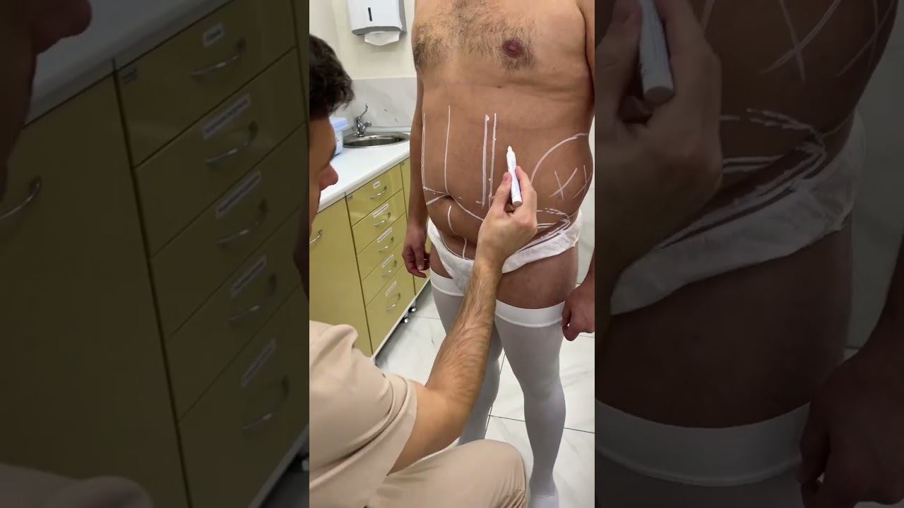 Подготовка к мужской липопластике