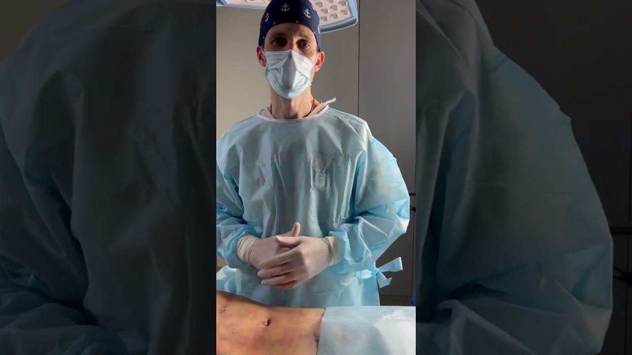 Мужская #липоскульптура с формированием рельефа живота и #липосакция поясницы