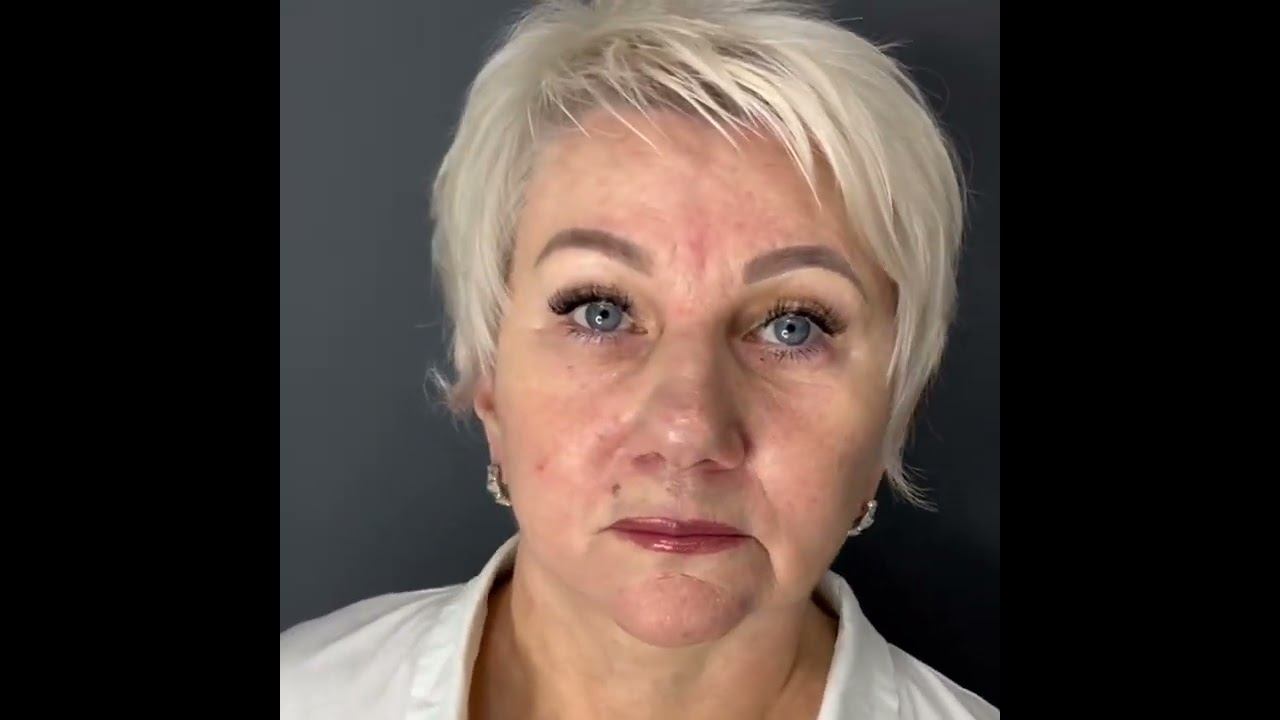 #SMAS_пластика: результат через 2 месяца