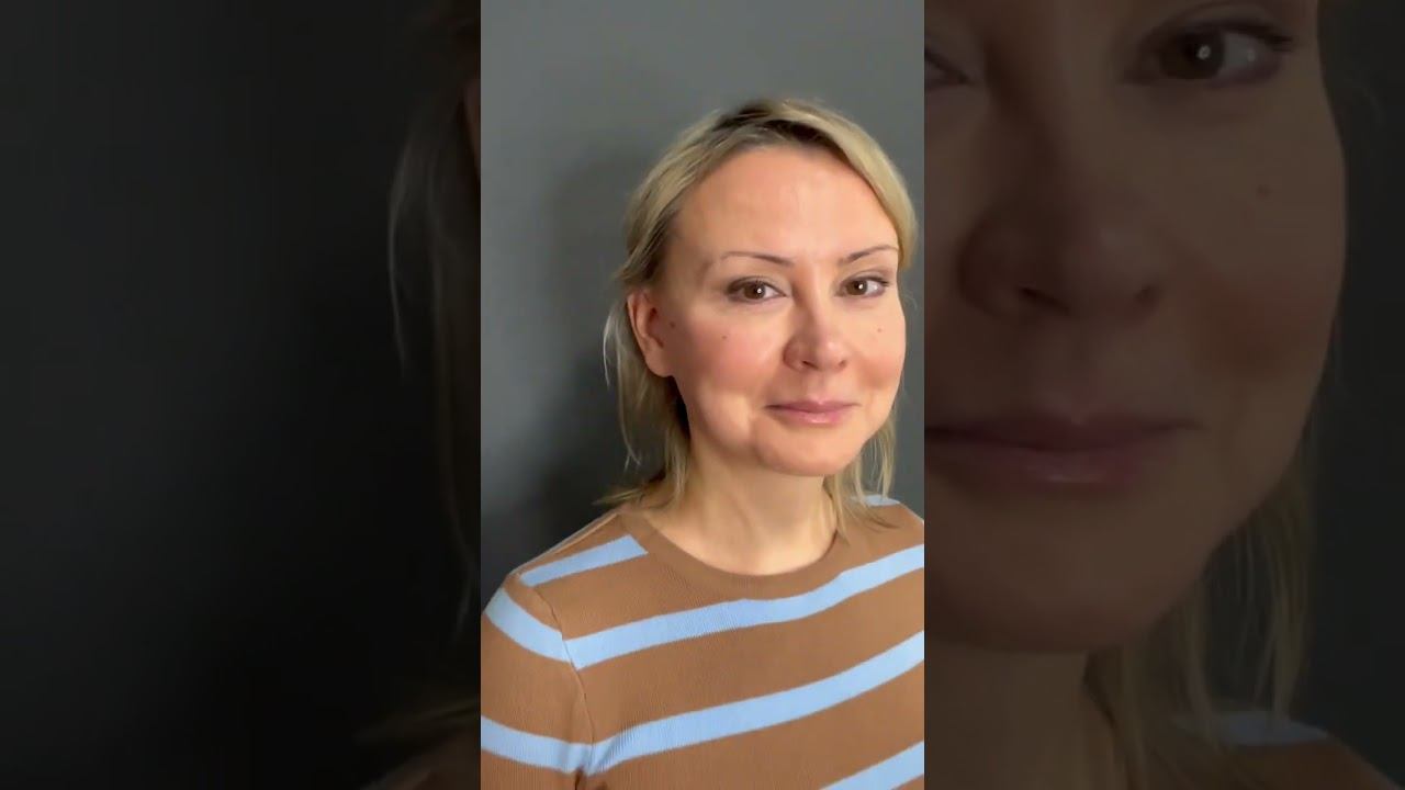 SMAS-пластика лица: через 8 месяцев