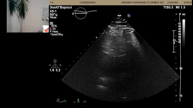 ЭХОКГ 56 лет мед осмотр . Смотрим, все ли нормально.