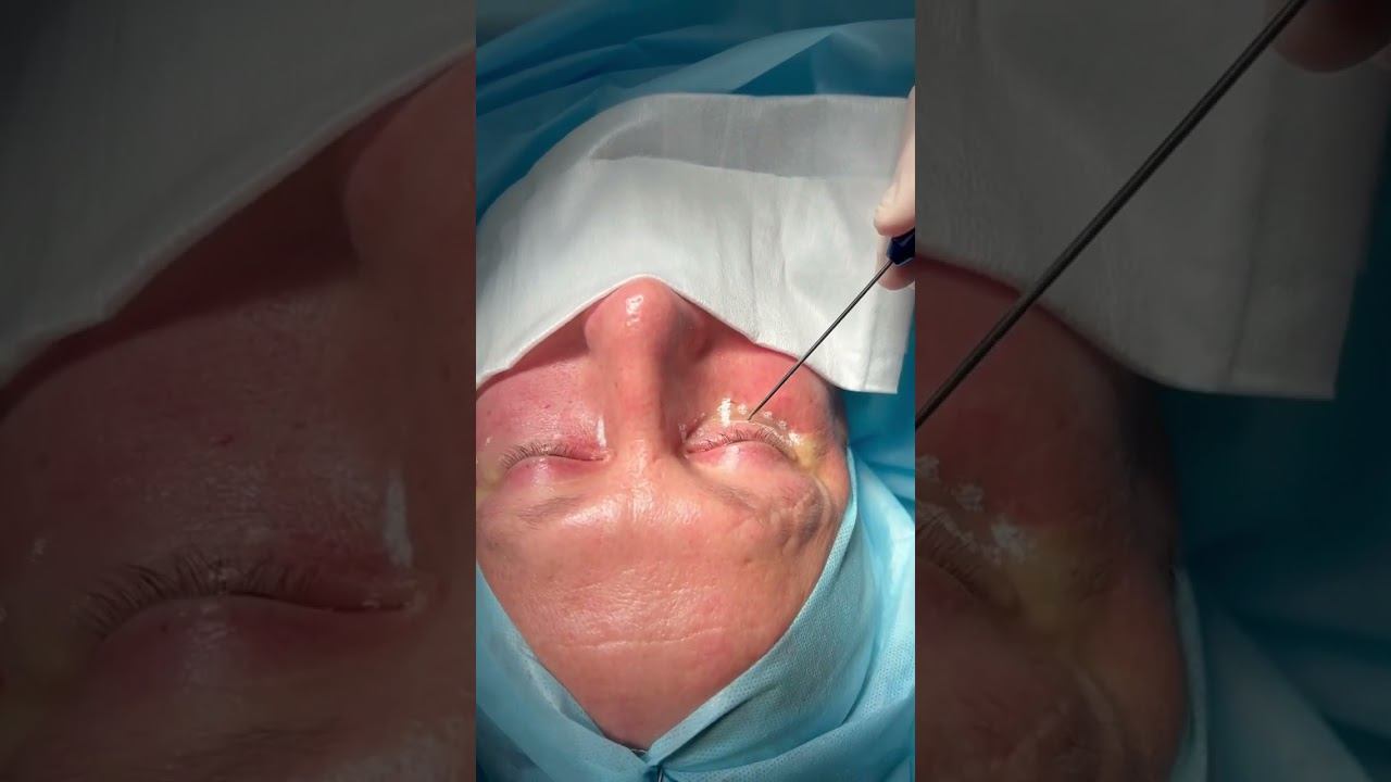 Липофилинг орбитальной области