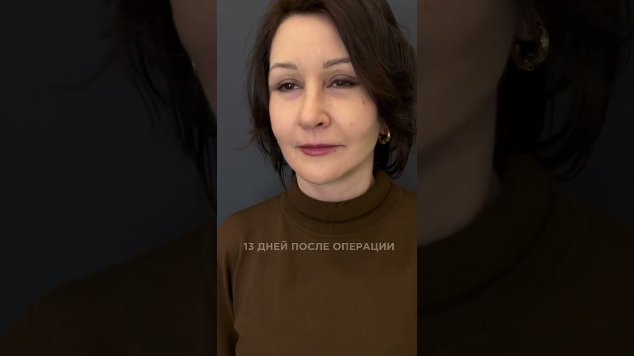 Подтяжка лица, эндоскопическая подтяжка лба, нанолипофилинг спустя 13 дней #эндоскопическаяподтяжка