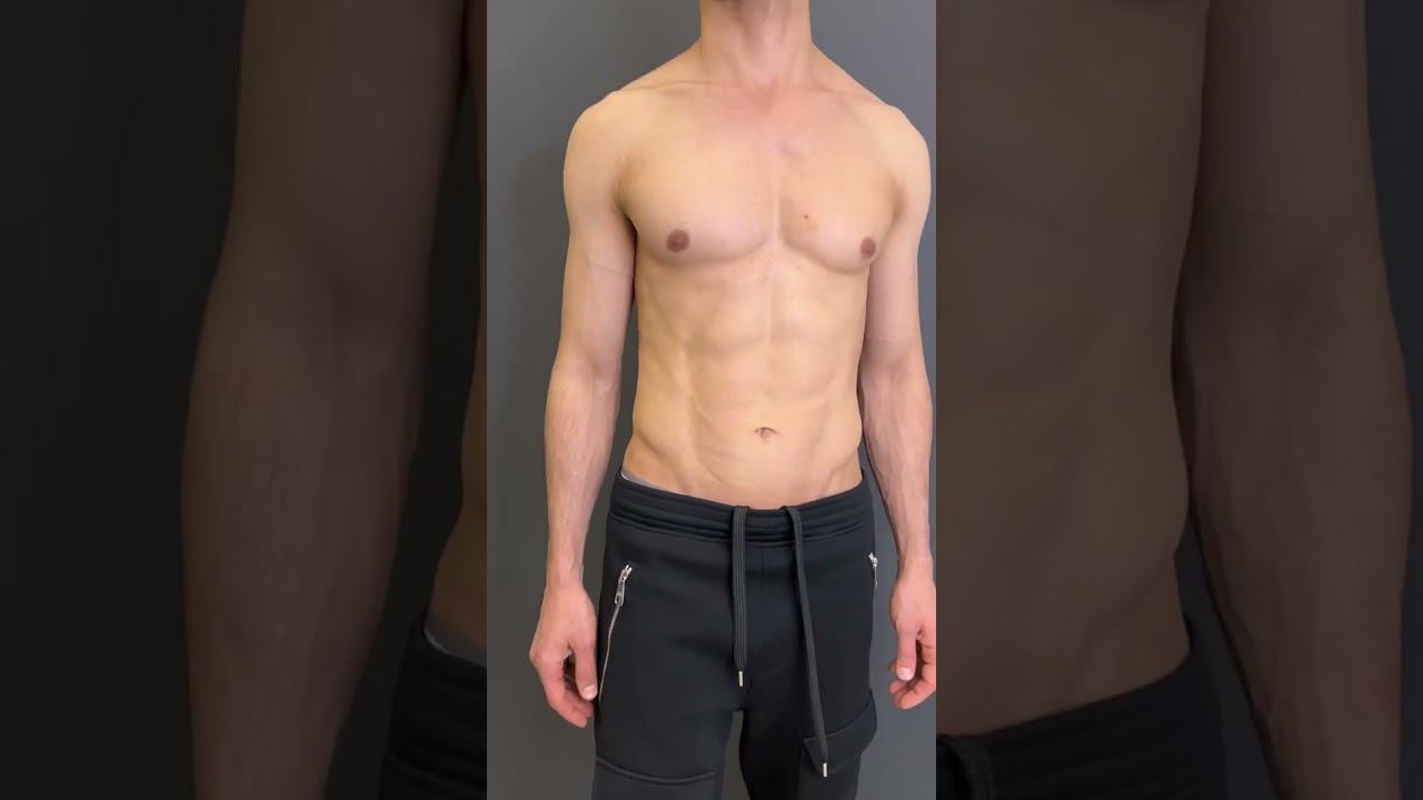 Мужская #липоскульптура спустя 1 год