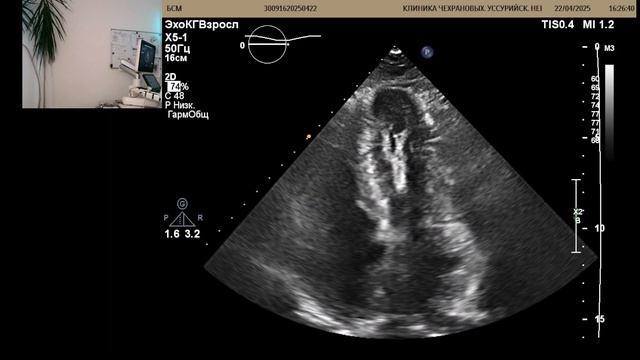 эхокг 70 лет  ,  состояние после стентирования 4 года назад.