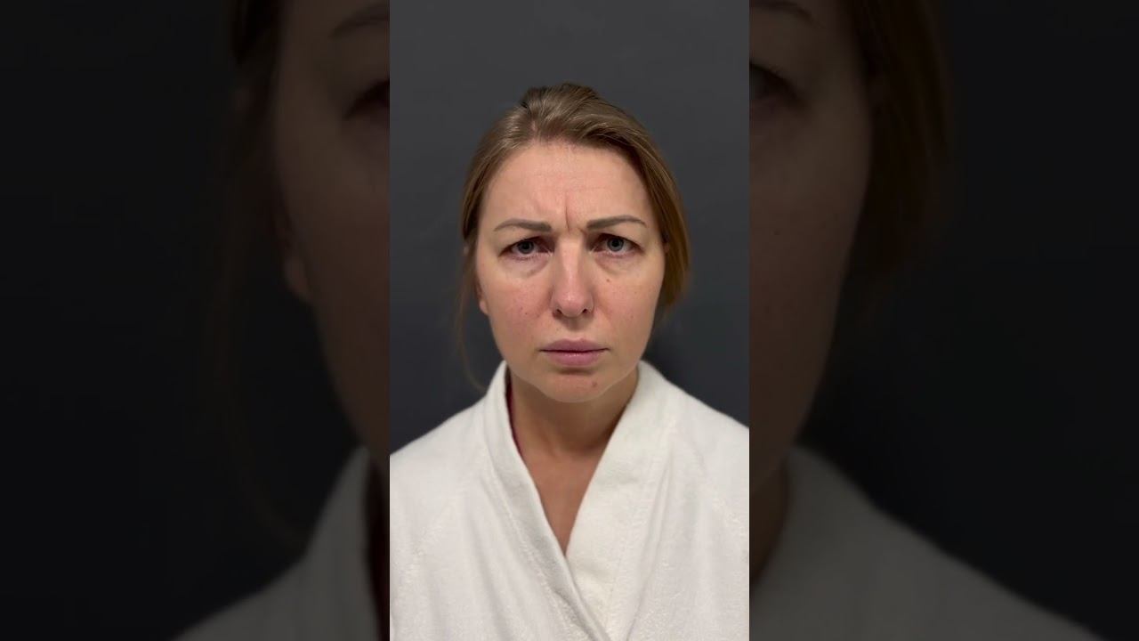 Эндоскопическая подтяжка верхней трети лица и круговая блефаропластика