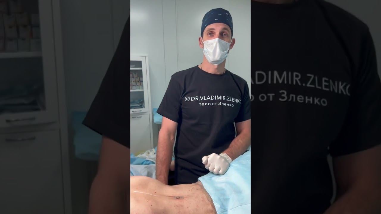 Абдоминопластика, липосакция и липофилинг: результат сразу после операции