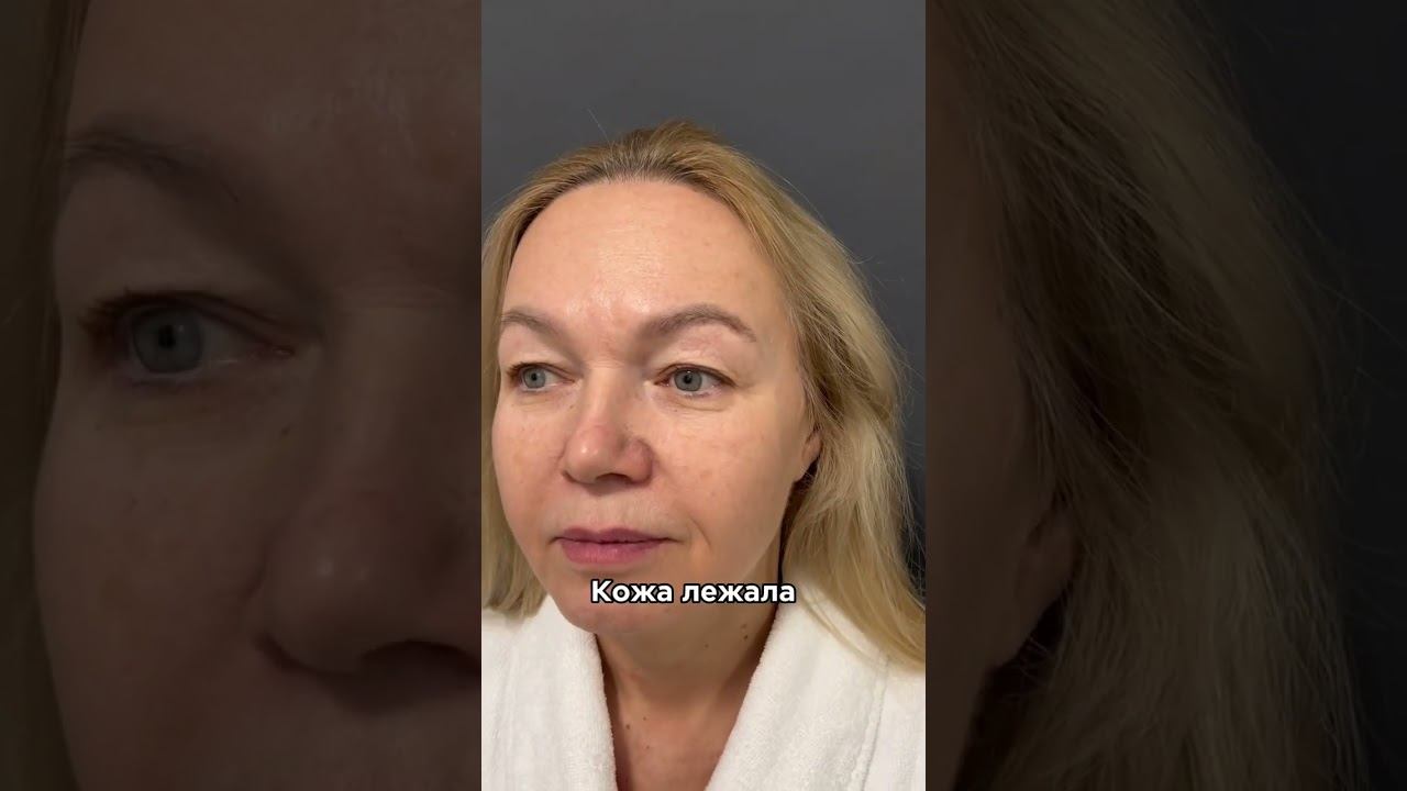 Верхняя #блефаропластикамосква