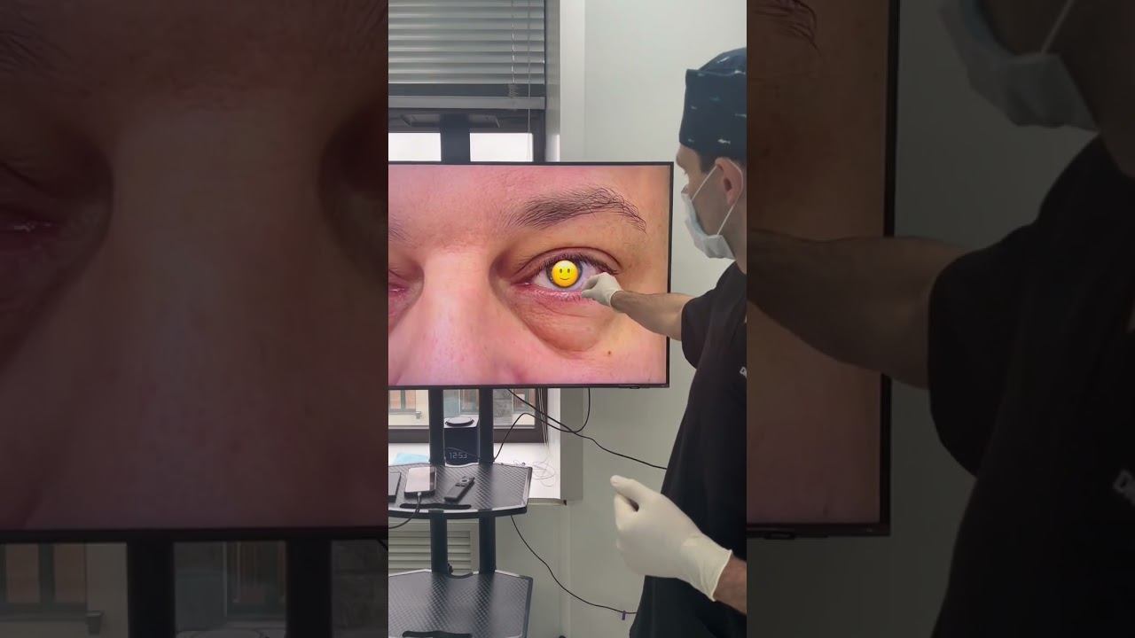 Мужская #блефаропластика: особенности