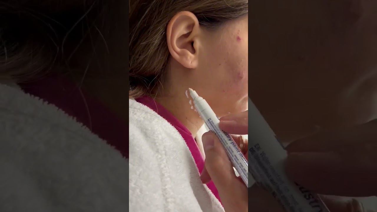 #липомоделирование овала лица