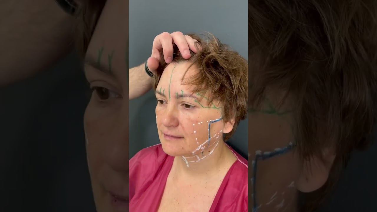 SMAS-пластика, #эндоскопическая подтяжка лба и #липосакция