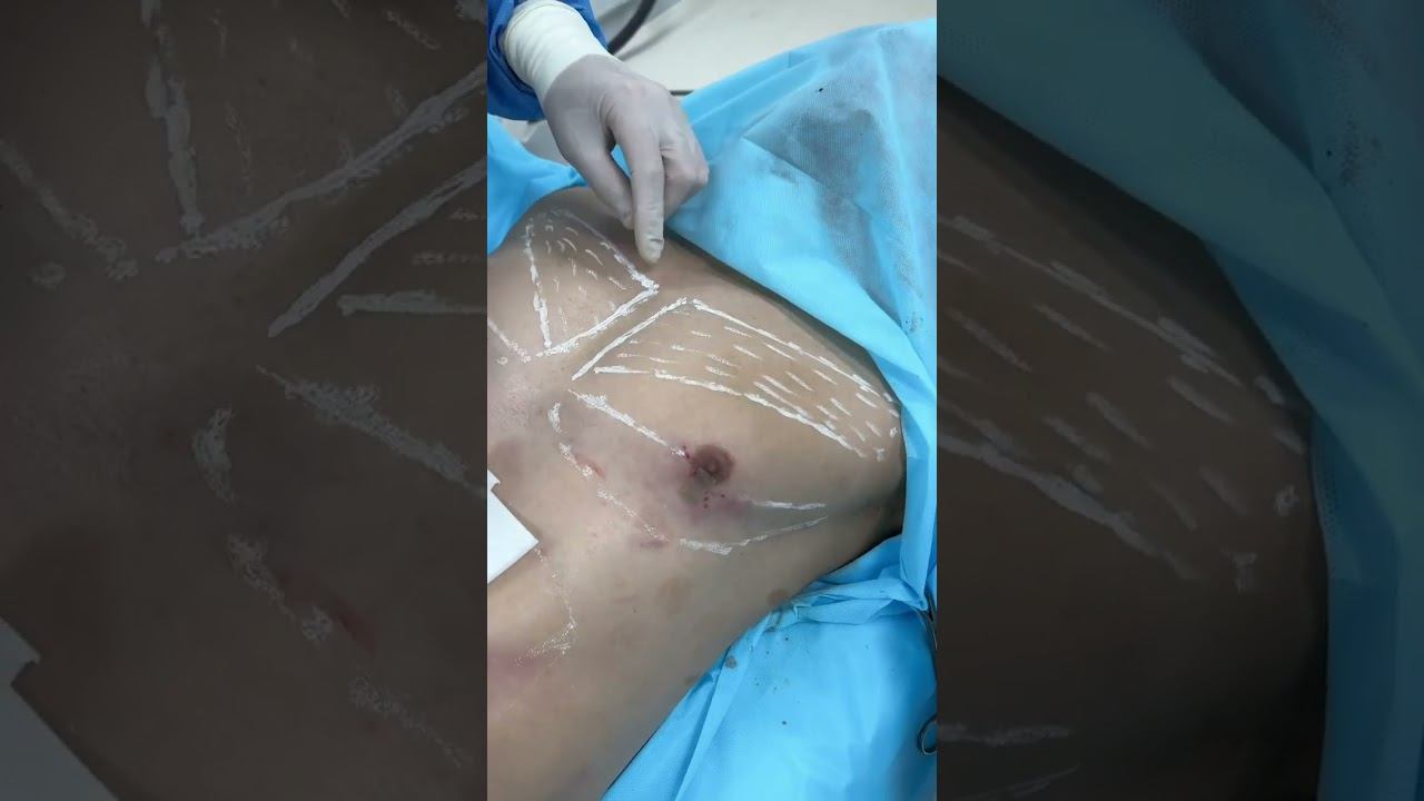 В операционной: процесс липоскульптурирования