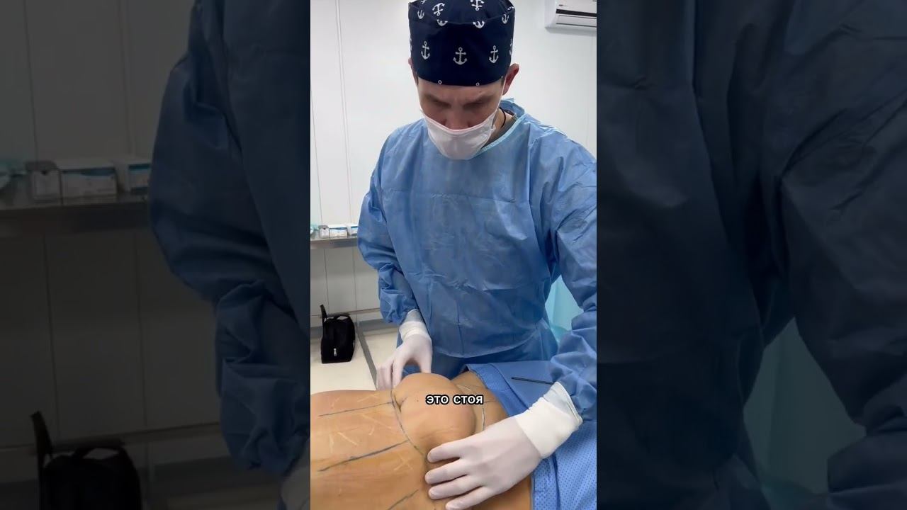 Липосакция и абдоминопластика