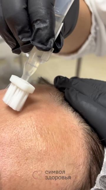 Подготовка к лазерной шлифовке лица