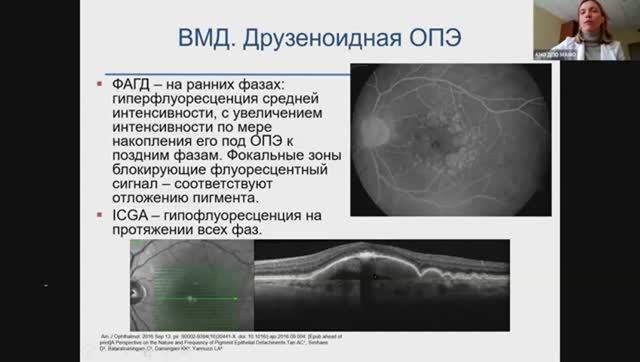 Вебинар ОКТ в диагностике отслойки ретинального пигментного эпителия