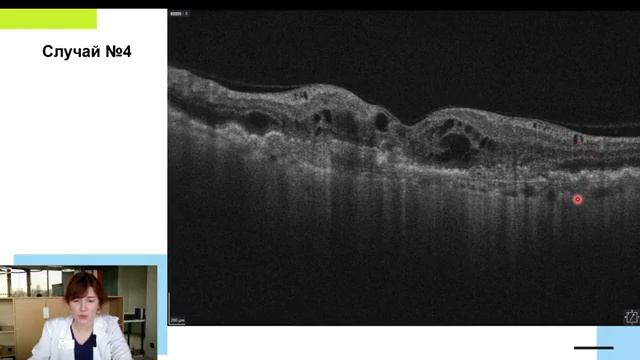 Взгляд сквозь слои_ эффективные подходы к анализу снимков ОКТ