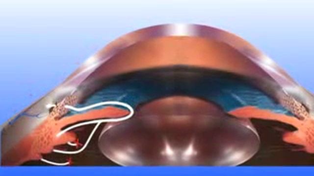 Академия Глаукомы. Механизм действия- Ксалаком