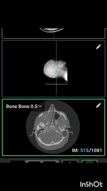 ПроЗдоровье.Операция на верхнечелюстной пазухе.Фильм1.Серия4.Часть6.mp4