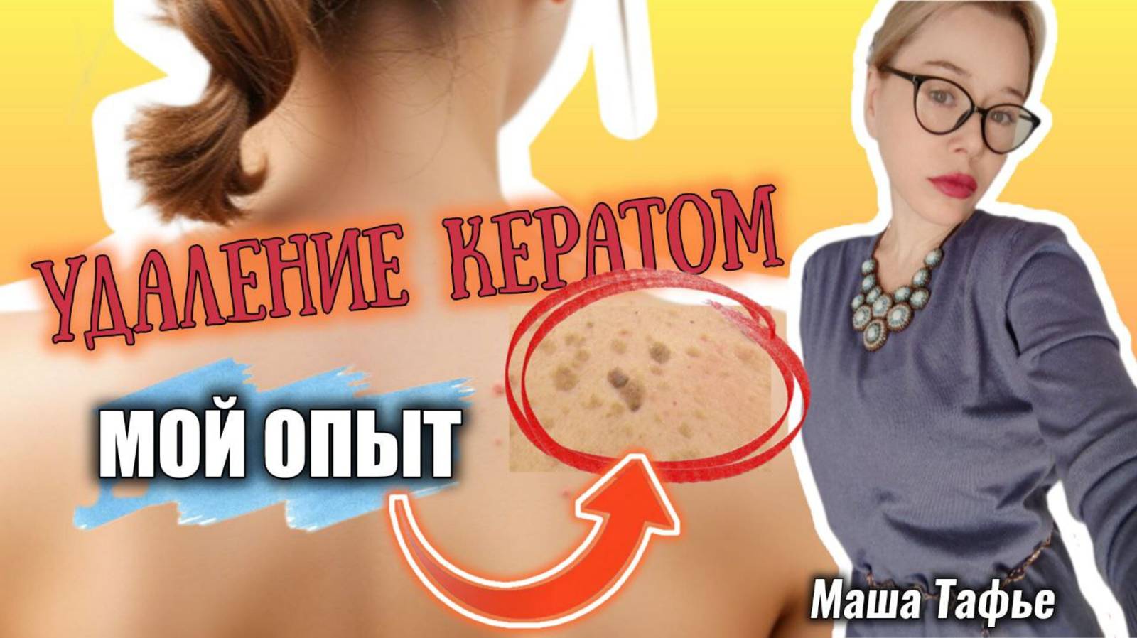 Удаление кератом. Мой опыт. Весна с Машей 🌷 Видео №61