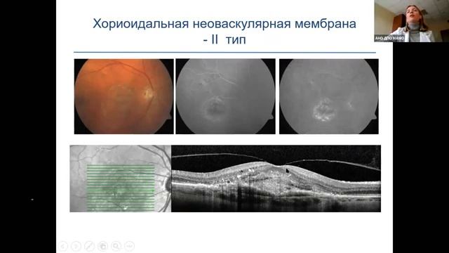 Вебинар ОКТ в диагностике отслойки ретинального пигментного эпителия