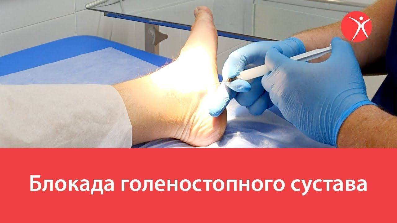 Блокада голеностопного сустава
