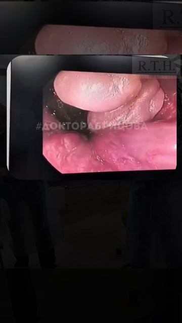 Что может выпадать из заднего прохода?