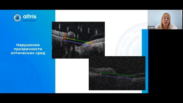 Артефакты в ОКТ
