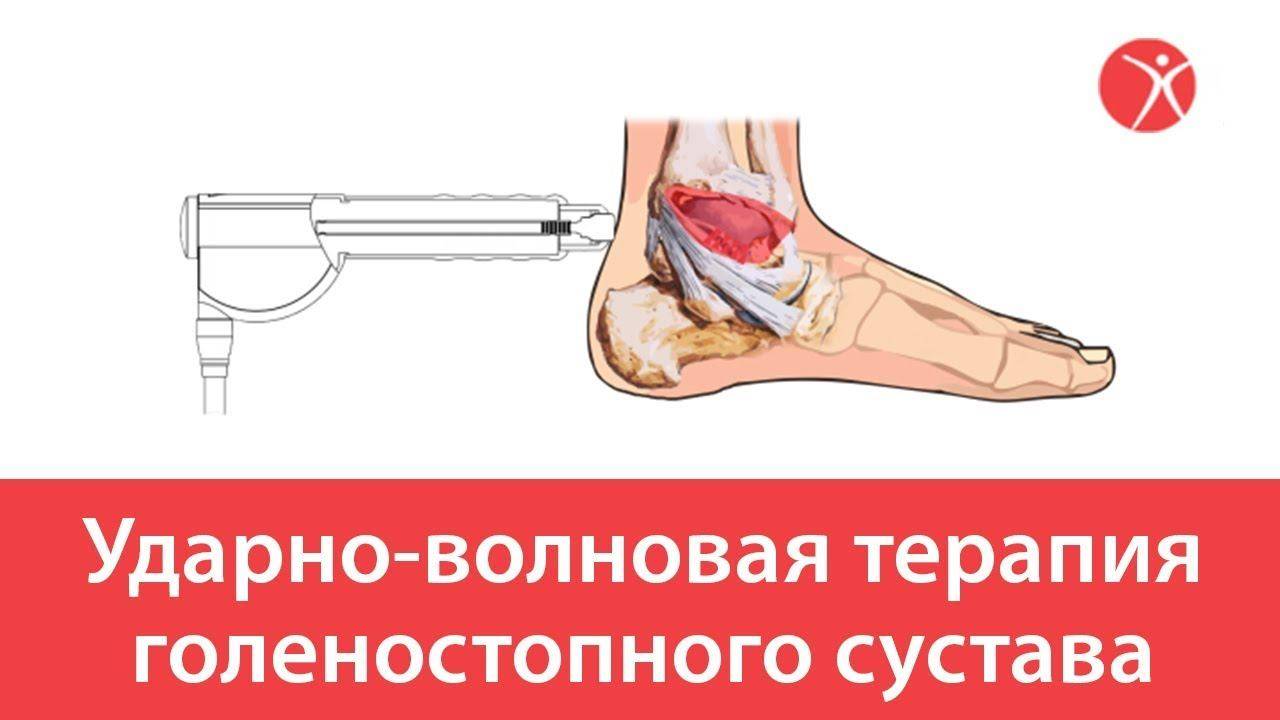 Ударно-волновая терапия голеностопного сустава в клинике Стопартроз