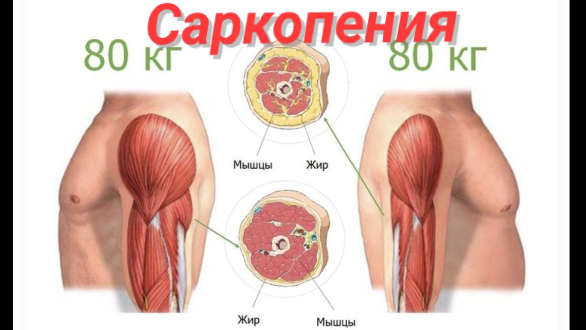 Саркопения. Потеря мышечной массы и силы.