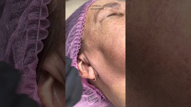 Лазерная шлифовка лица на аппарате Deka SmartXide 2 Touch