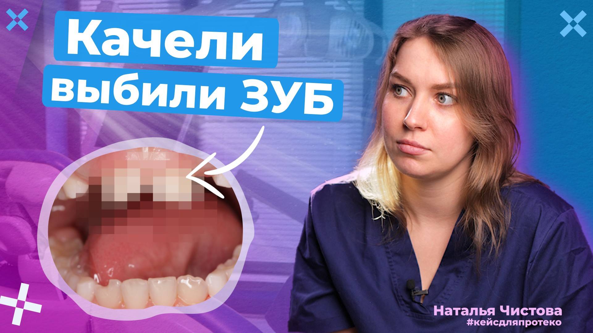 Как мы спасли передние зубы после травмы | Временная реставрация перед ортодонтическим лечением