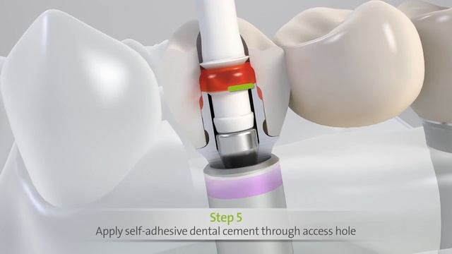 Демонстрация процесса вклейки Variobase