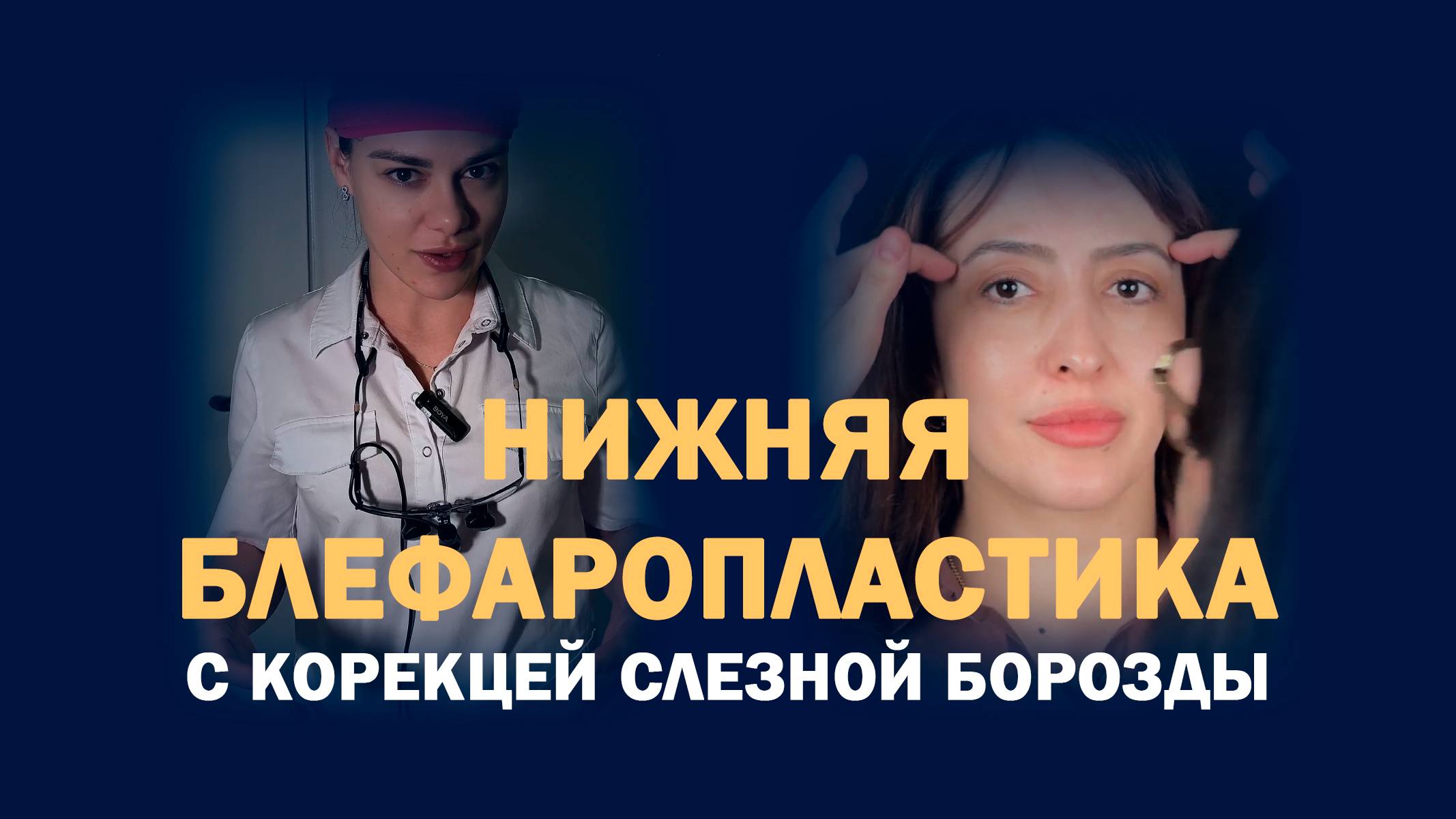 Нижняя блефаропластика с перемещением жировых грыж: результат через год