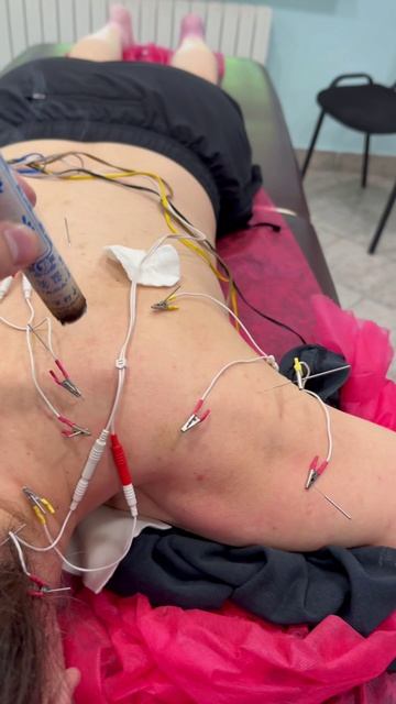 Термоэлектроакупунктура в лечении радикулопатии.