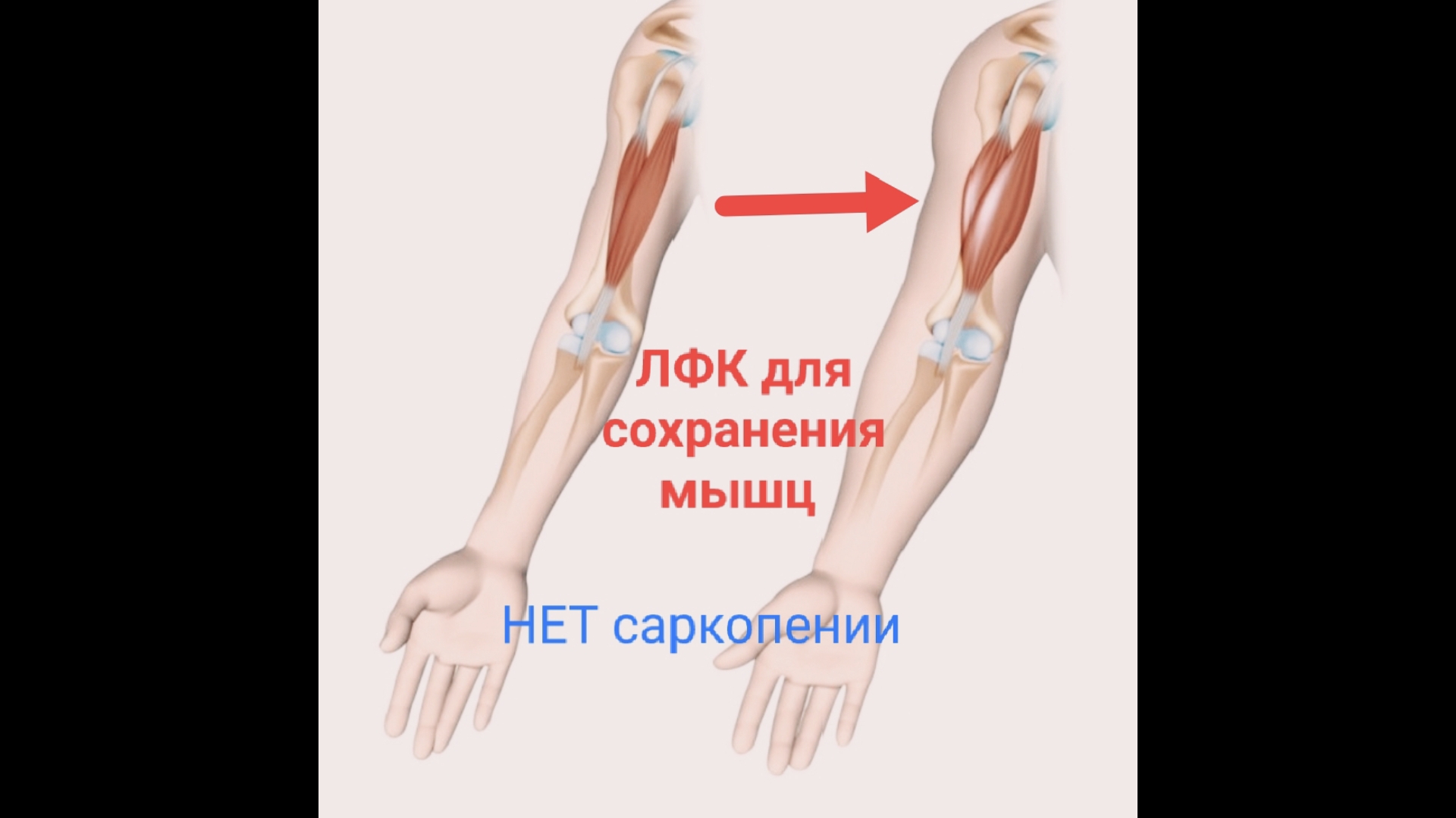 ЛФК VS саркопении. Ежедневные упражнения для сохранения мышц.