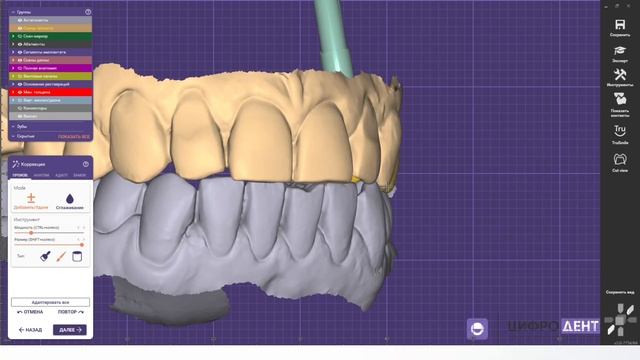 Моделирование временных коронок и адаптация модели под печать