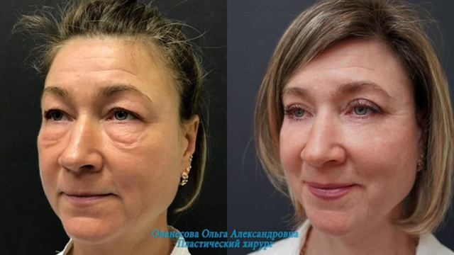 Может ли пластика изменить характер человека?