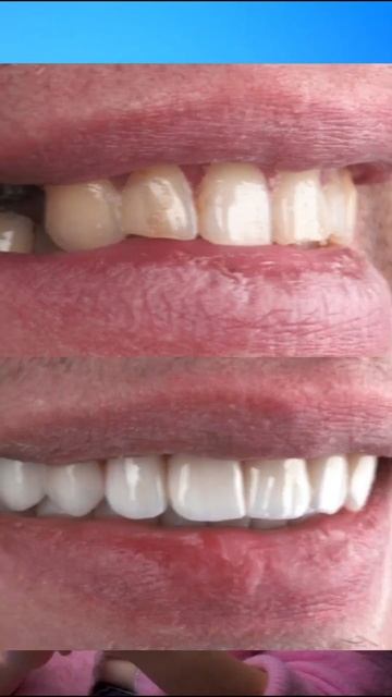 ПОЧЕМУ НЕЛЬЗЯ ОТКЛАДЫВАТЬ ЛЕЧЕНИЕ ЗУБОВ? 🦷 #SHORTS