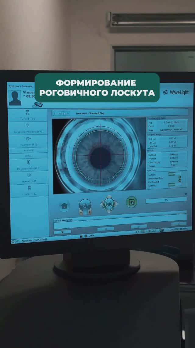 Операция по лазерной коррекции зрения Фемто Ласик (Femto Lasik)