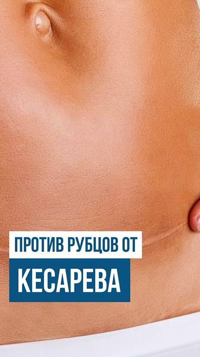 КЕСАРЕВО СЕЧЕНИЕ: КАК УБРАТЬ РУБЕЦ