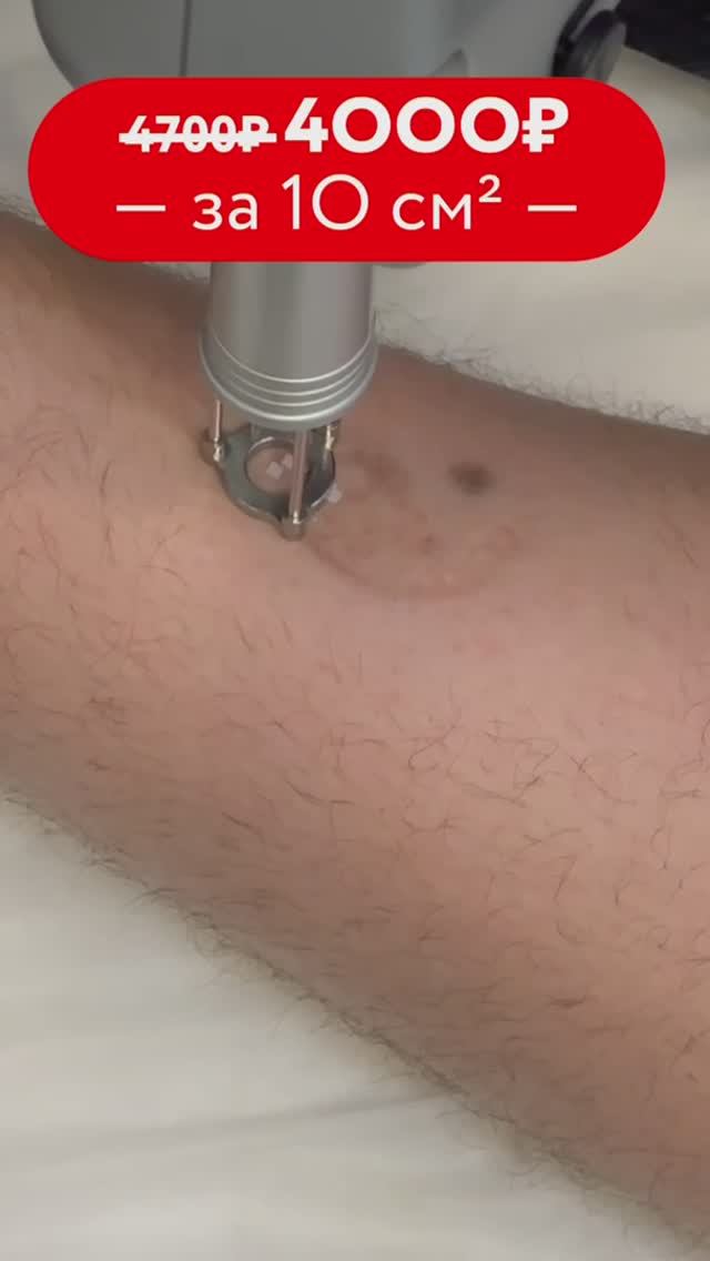 Удаление тату в медицинском центре H2O Life. Попробуй магию на себе!