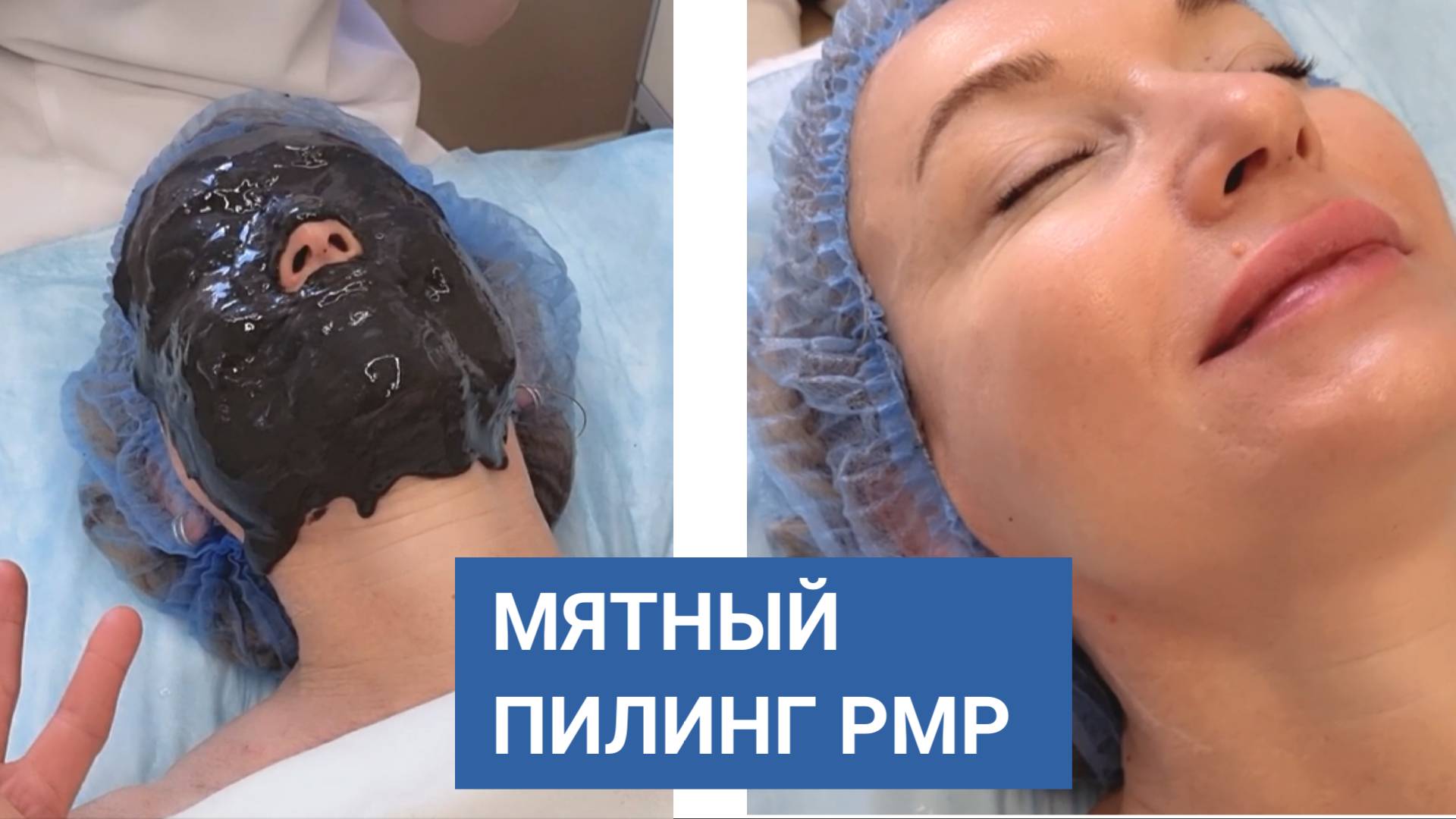 «Мятный пилинг»/PMP-пилинг - преимущества процедуры. Детальный обзор #мохитопилинг #косметология