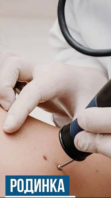 Нужно ли удалять родинку?