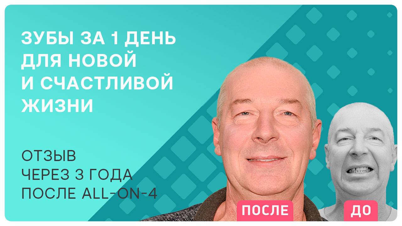 Оправдались ли страхи, связанные с имплантацией всех зубов? Делюсь личным опытом