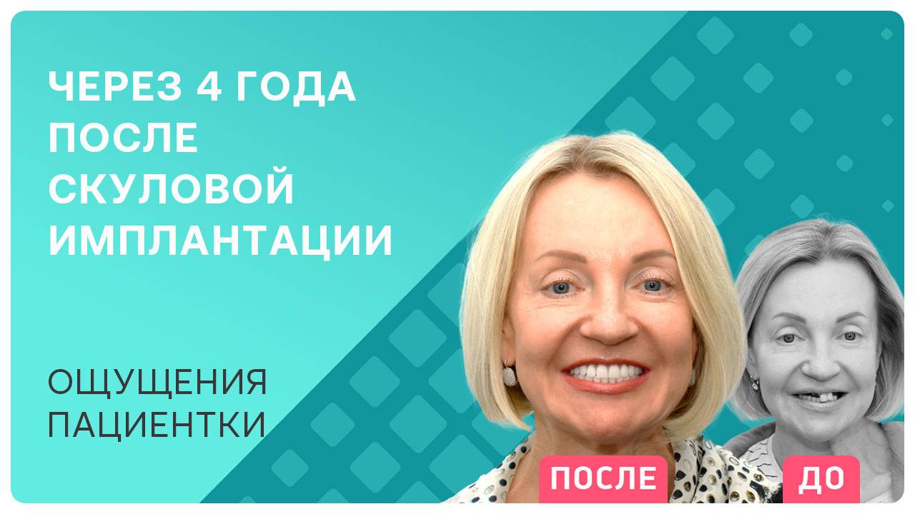 Что будет со скуловыми имплантами через 4 года после установки?