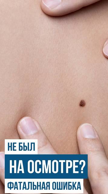 МНОГО РОДИНОК? РАЗ В ГОД НА ОСМОТР! #новообразования #онкология #советыврача