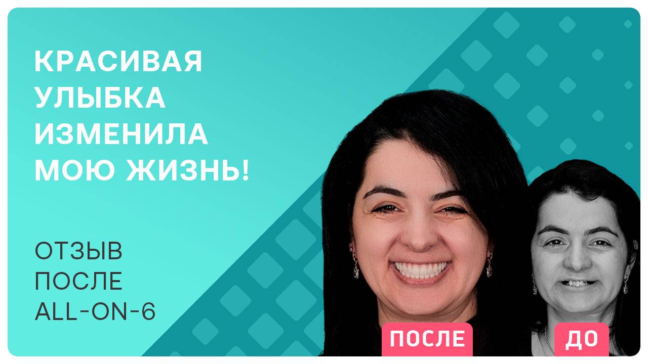Ощущения молодой пациентки после имплантации всех зубов